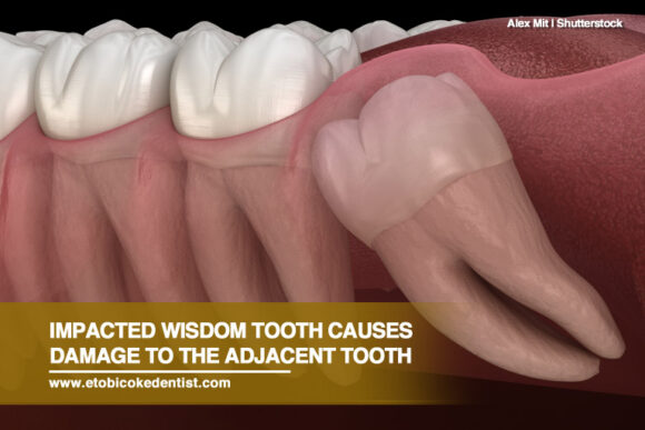 Interesting Facts About Wisdom Teeth - Dr. Mark Rhody Dentistry